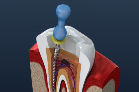 Root Canal Logan | Root Canal Treatment Logan Village
